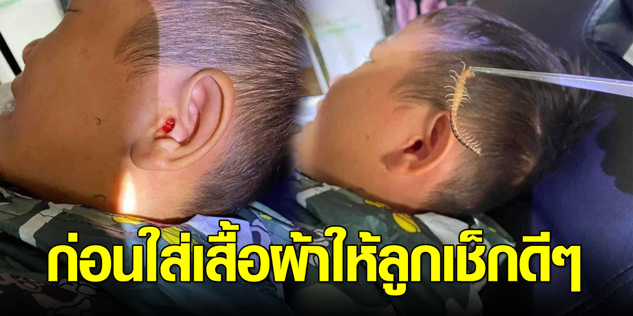 เตือนผู้ปกครอง ใส่เสื้อให้ลูกเช็กดีๆ อุทาหรณ์ตะขาบอยู่ในเสื้อเข้าหูลูก